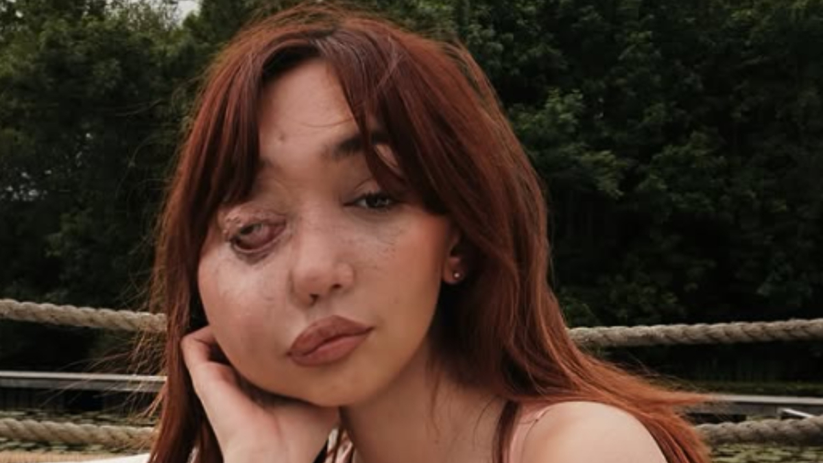 Nikki Lilly, la influencer con una enfermedad rara en la cara que es ...