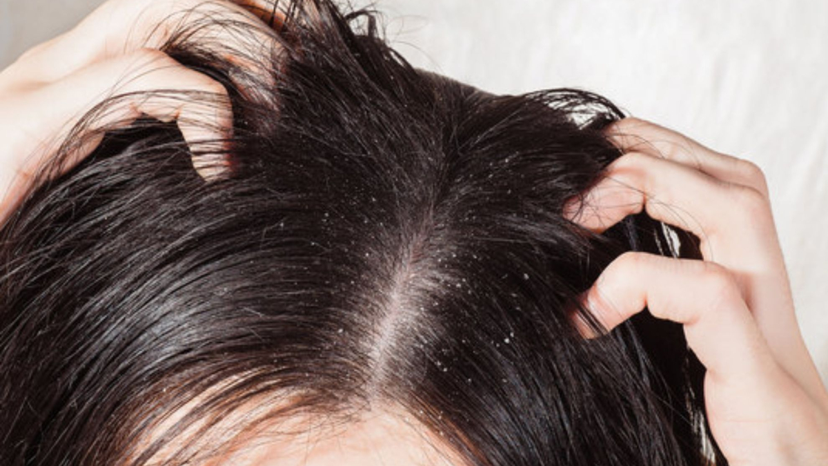 La mejor fórmula de eliminar la caspa de pelo y cejas: “Esas escamas ...