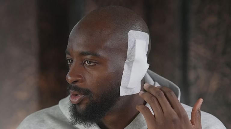 Mateta, tras sufrir una brutal patada de 25 puntos: "Tenía la oreja ...