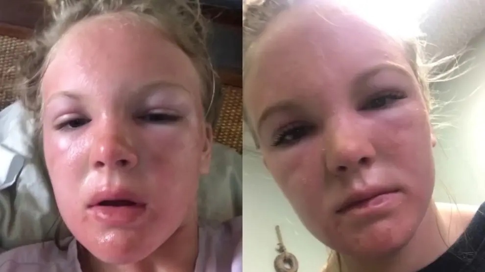 Una joven se queda dormida en la playa y queda "irreconocible" por una ...
