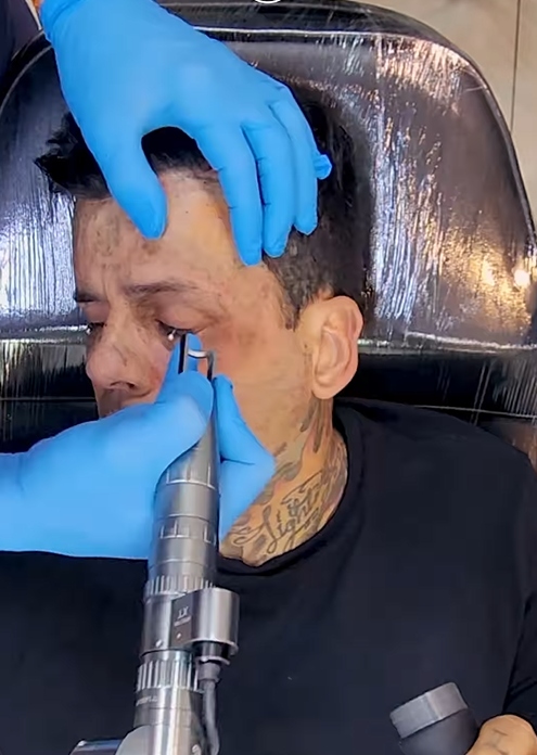 El hombre más tatuado del mundo muestra su nueva cara tras quitarse ...