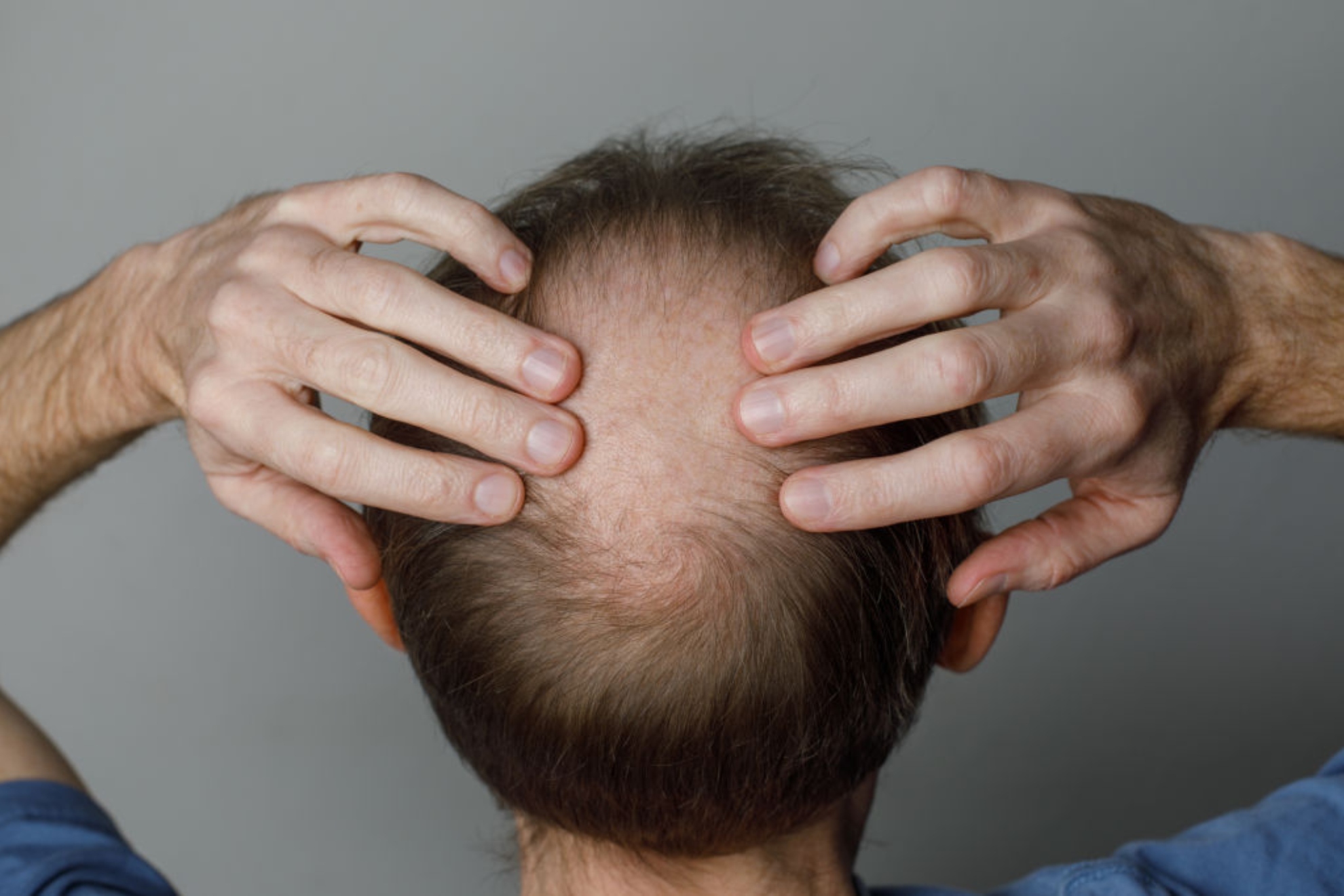 Adiós a la alopecia: un grupo de expertos da con un tipo de medicamento ...